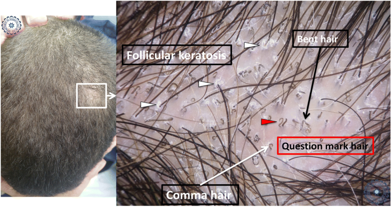 A prospective study of tinea capitis in children: making the diagnosis ...