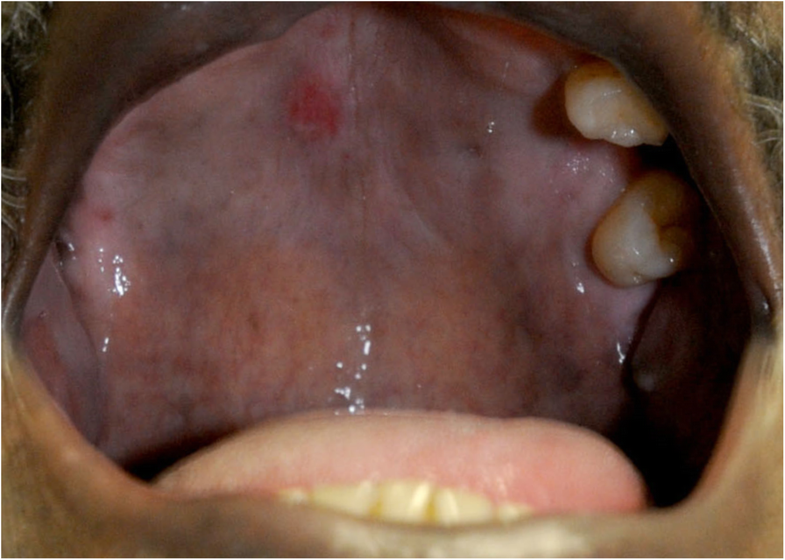 The oral manifestations of syphilitic disease: a case report | SpringerLink