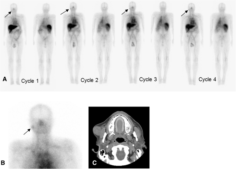 Indium 111-labeled J591 anti-PSMA antibody for vascular targeted ...