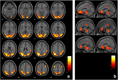 The cingulate island sign within early Alzheimer’s disease-specific ...
