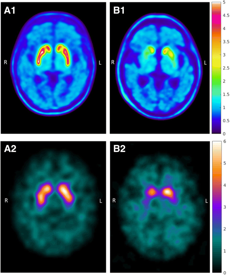 Dopamine transporter imaging with [18F]FE-PE2I PET and [123I]FP-CIT ...