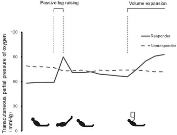 Fluid responsiveness predicted by transcutaneous partial pressure of ...