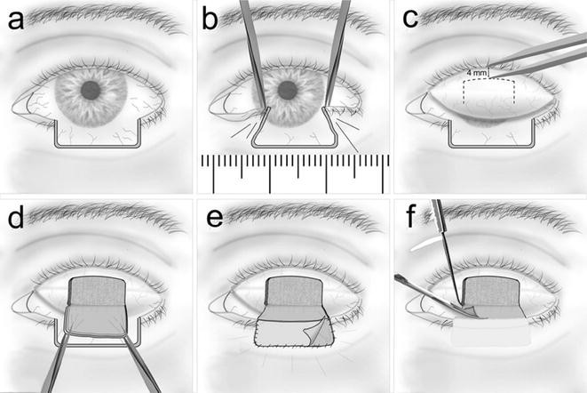 Modified Hughes procedure for reconstruction of large full-thickness ...
