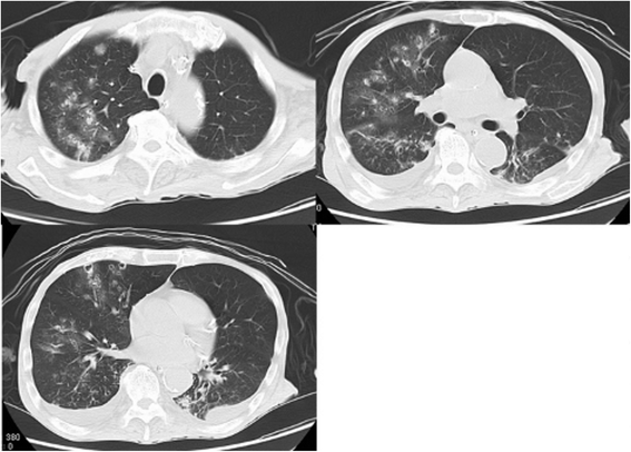 Invasive candidiasis presenting multiple pulmonary cavitary lesions on ...