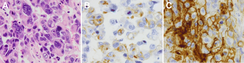 Alpha-fetoprotein (AFP) as tumor marker in a patient with urothelial ...