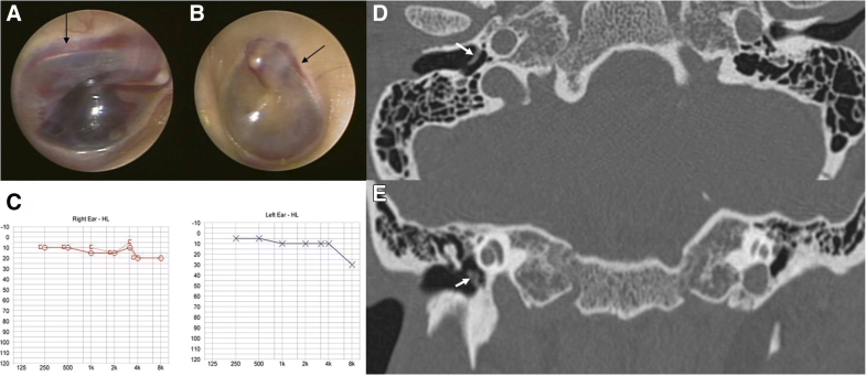 Hemorrhage within the tympanic membrane without perforation | Journal ...