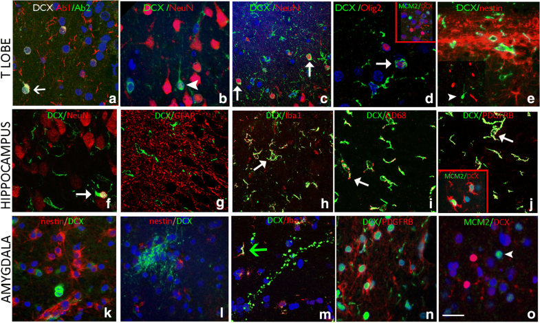 Doublecortin-expressing cell types in temporal lobe epilepsy | Acta ...