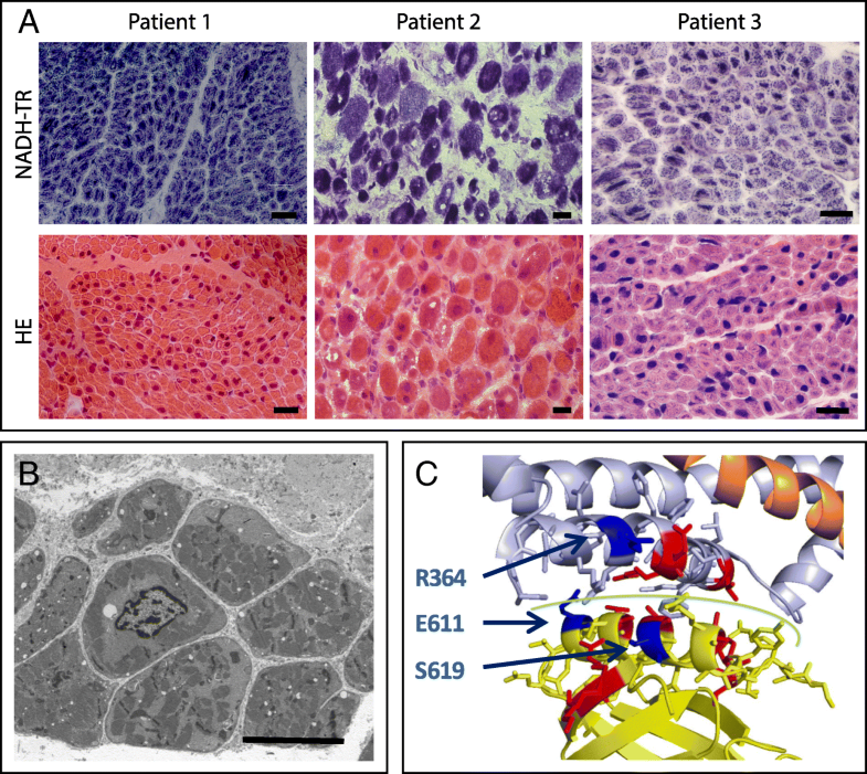 Some DNM2 mutations cause extremely severe congenital myopathy and ...