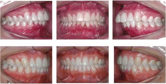 Stability of class II subdivision malocclusion treatment with 3 and 4 ...