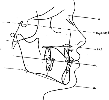 Comparison of two maxillary protraction protocols: tooth-borne versus ...