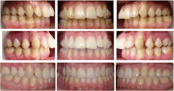 Maxillary molar distalization with aligners in adult patients: a ...
