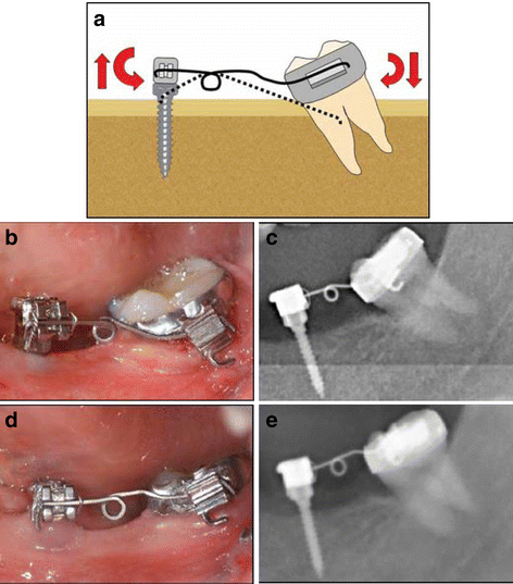 Mandibular molar uprighting using orthodontic miniscrew implants: a ...