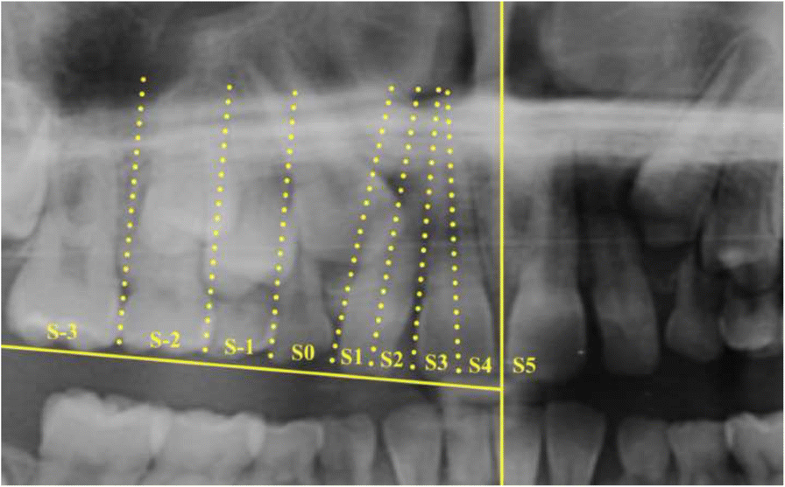 Early diagnosed impacted maxillary canines and the morphology of the ...