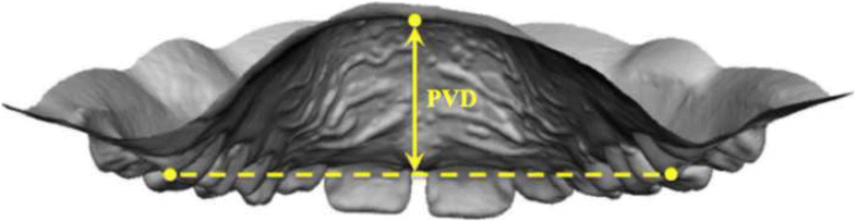 Early diagnosed impacted maxillary canines and the morphology of the ...