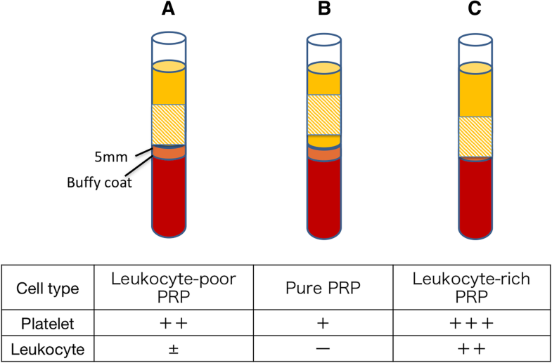 Optimization of leukocyte-poor platelet-rich plasma preparation: a ...