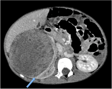 Neuroblastoma and nephroblastoma: a radiological review | Cancer ...