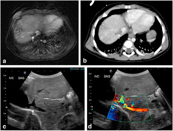 MRI of paediatric liver tumours: How we review and report | Cancer ...