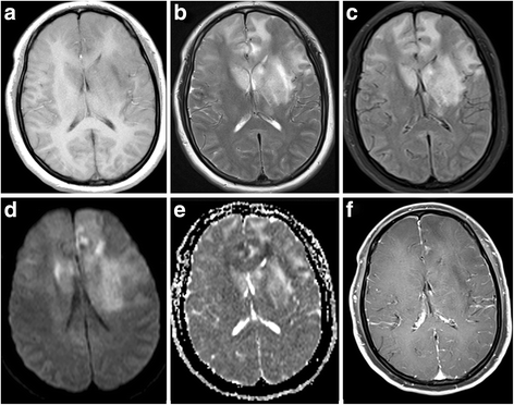 Lymphomatosis cerebri: a rare variant of primary central nervous system lymphoma and MR imaging ...