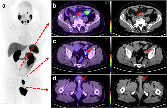 68Ga PSMA-11 PET with CT urography protocol in the initial staging and biochemical relapse of ...
