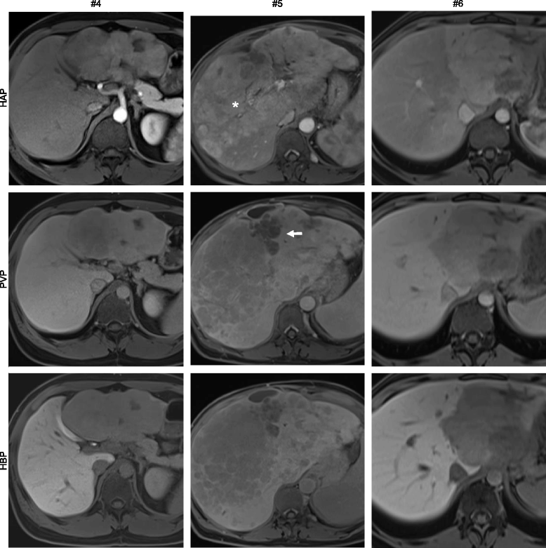 Imaging features of fibrolamellar hepatocellular carcinoma in gadoxetic acid-enhanced MRI ...