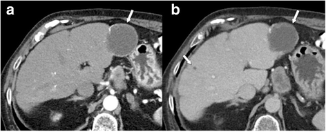 LI-RADS v2017 for liver nodules: how we read and report | Cancer ...