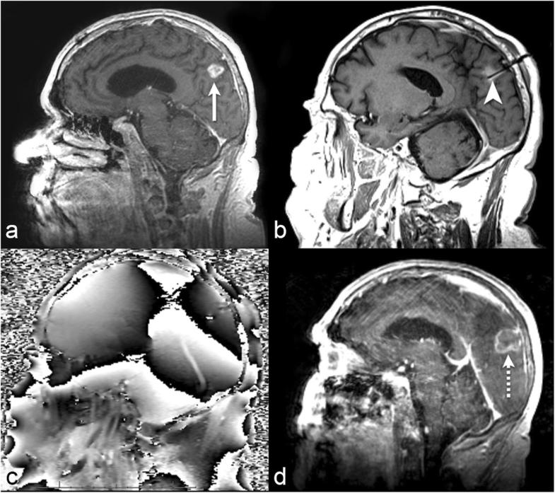 Neurosurgical applications of MRI guided laser interstitial thermal ...