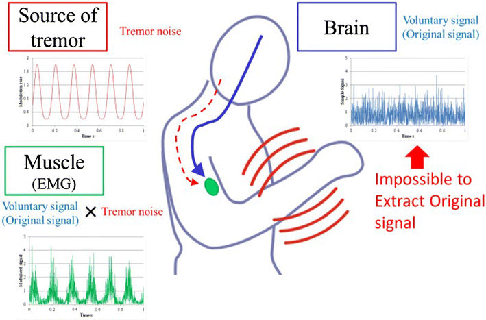Algorithm to demodulate an electromyogram signal modulated by essential ...