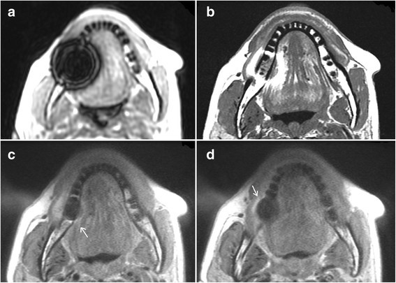 Metal artifact reduction in patients with dental implants using ...