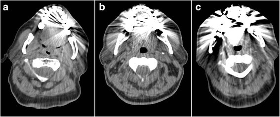Metal artifact reduction in patients with dental implants using ...