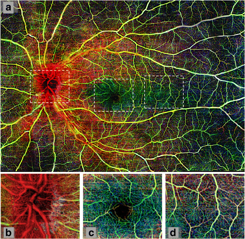 Emerging Applications of Optical Coherence Tomography Angiography (OCTA ...