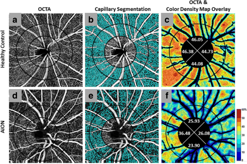 Emerging Applications of Optical Coherence Tomography Angiography (OCTA ...