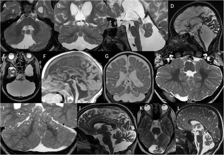 Terminology in morphological anomalies of the cerebellum does matter ...
