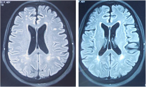 Progressive cerebellar degeneration revealing Primary Sjögren Syndrome ...