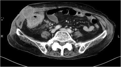 Right axillary lymph node metastasis of carcinoma of the cecum with ...
