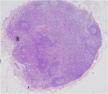 Right axillary lymph node metastasis of carcinoma of the cecum with ...