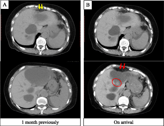 Rerupture of nonparasitic liver cyst treated with cyst fenestration: a ...
