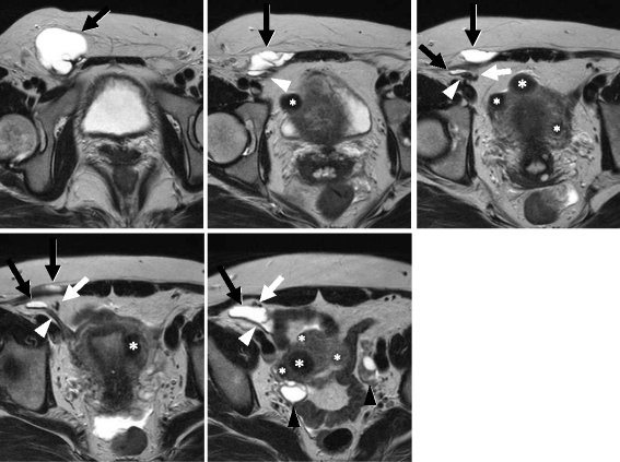 Hydrocele of the canal of Nuck: a case report with magnetic resonance ...
