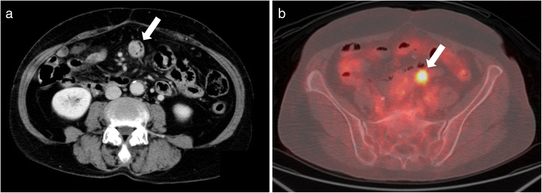 Adenocarcinoma arising from jejunal ectopic pancreas mimicking ...