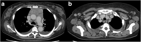 A case of TAFRO syndrome with a large mediastinal mass treated with ...