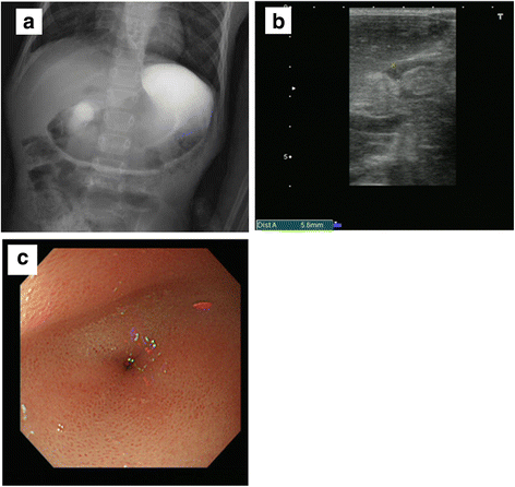 Successful combination of endoscopic pyloromyotomy and balloon ...