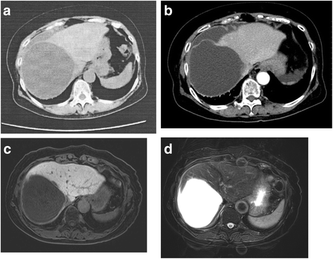 Elective laparoscopic deroofing to treat the spontaneous rupture of a ...
