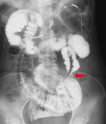 Usefulness of a laparoscopic approach for treatment of small-bowel ...