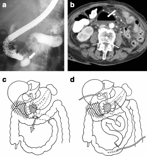 Management of horizontal duodenal perforation: a report of three cases ...