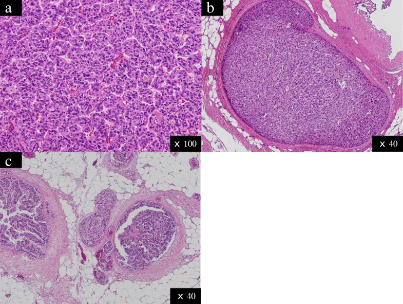 Detection of needle tract implantation and peritoneal seeding after ...