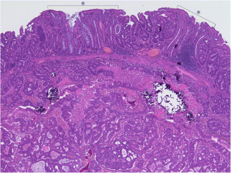 Metachronous rectal metastasis from primary transverse colon cancer: a ...
