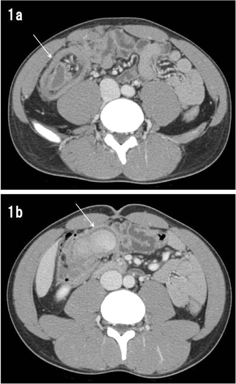 Stool filling of an intestinal duplication cyst at the ileocecal valve ...