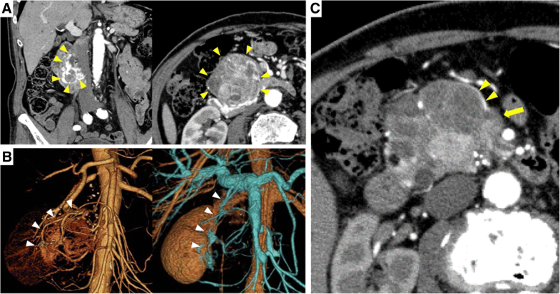A case of duodenal hemorrhage due to arteriovenous malformation around ...