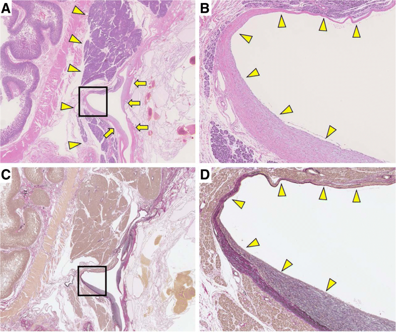 A case of duodenal hemorrhage due to arteriovenous malformation around ...