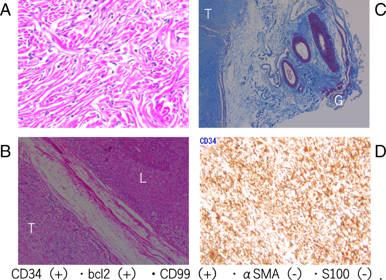 Laparoscopic treatment of a solitary fibrous tumor originating in the ...