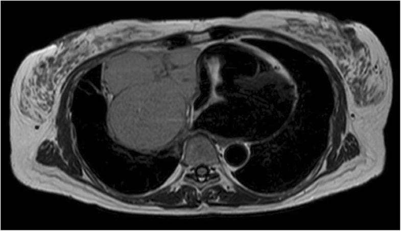 Lifesaving surgery for a ruptured invasive thymoma using the hemi ...
